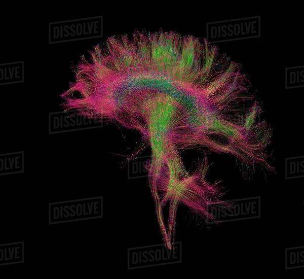 Diffusion MRI, also referred to as diffusion tensor imaging or DTI, of the human brain - Royalty ...