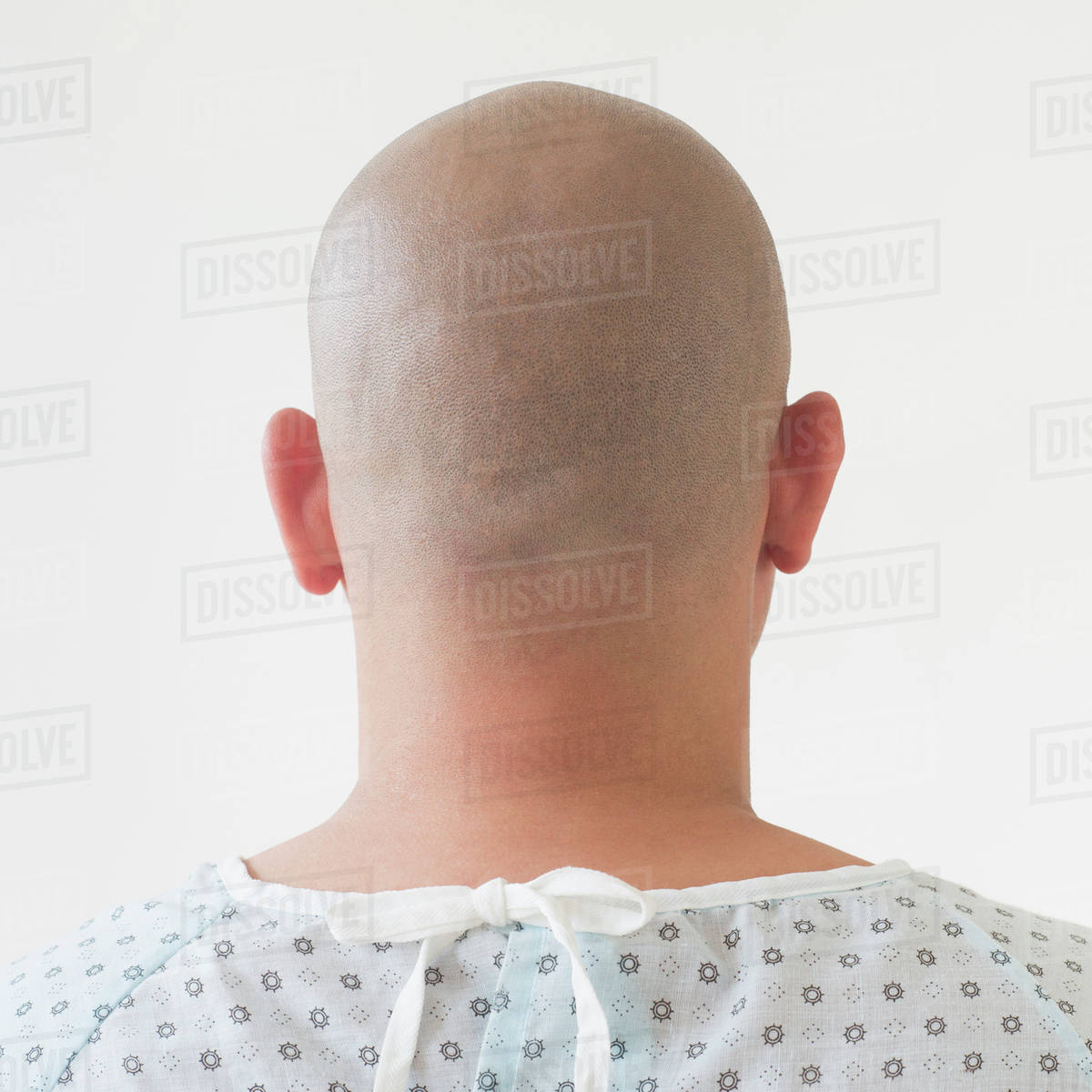 Back view of patient with shaved head - Royalty-free Stock Photo | Dissolve