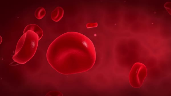 Microscopic visualization of sickle cells causing anemia disease ...