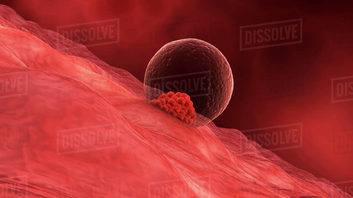 A blastocyst begins implanting in the wall of the uterus. - Stock Photo ...