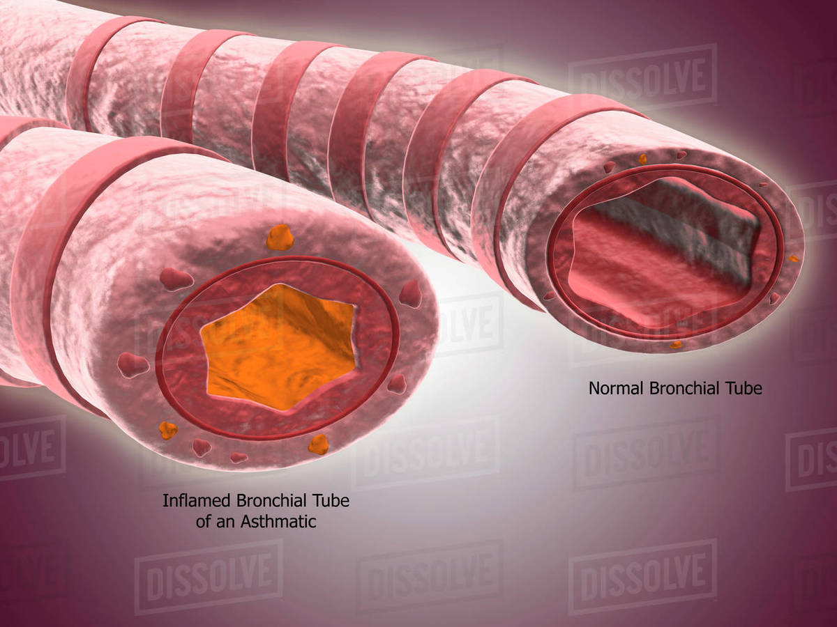 Trachea cross-section showing comparison of normal and asthmatic ...