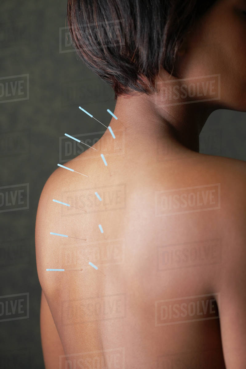 Acupuncture needles in African woman's back - Royalty-free Stock Photo | Dissolve