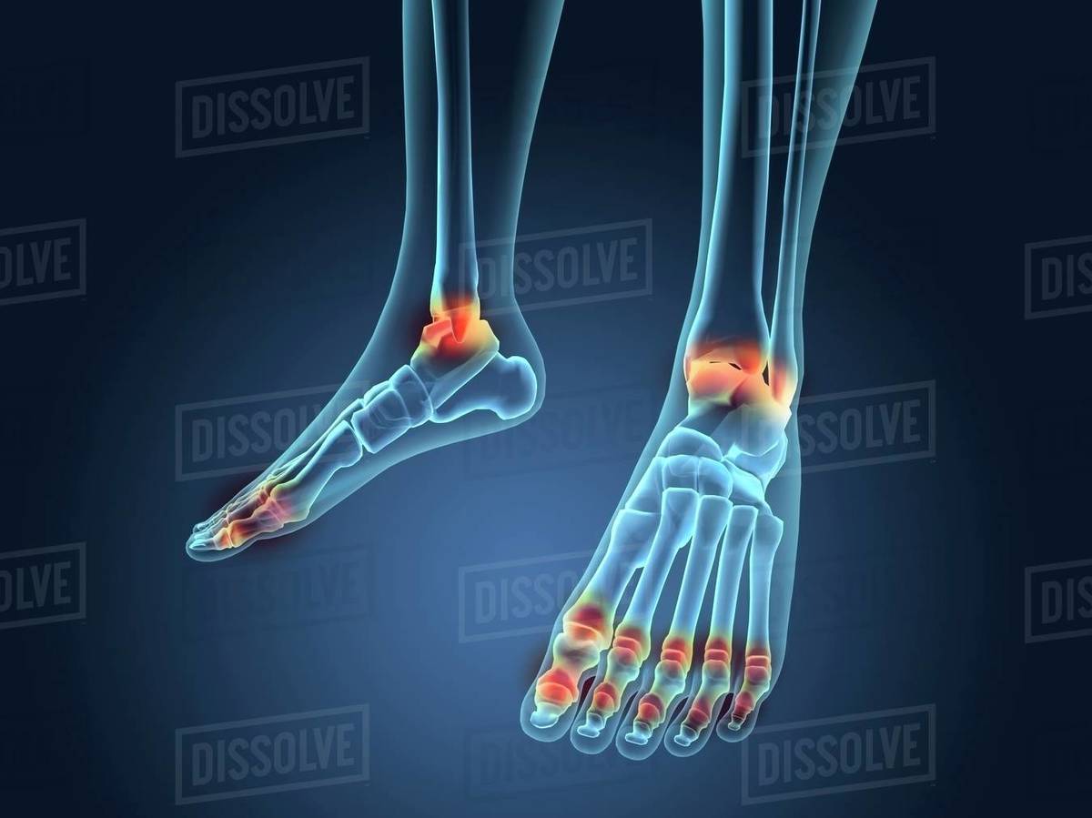 X-ray view of inflamed foot bones - Royalty-free Stock Photo | Dissolve