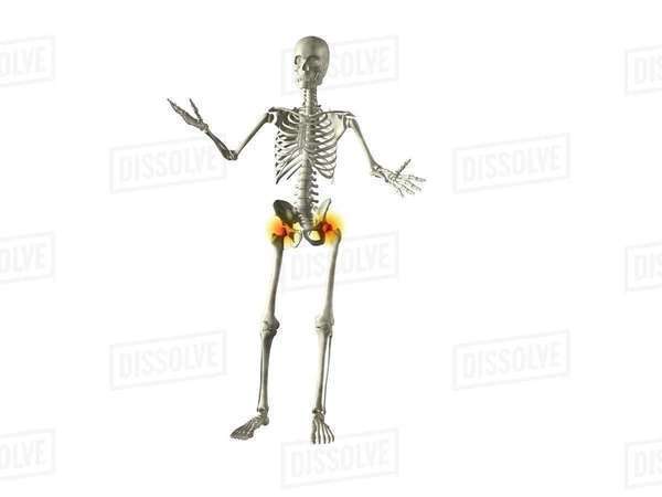 X-ray view of a human skeleton with hip joint inflammation - Royalty ...