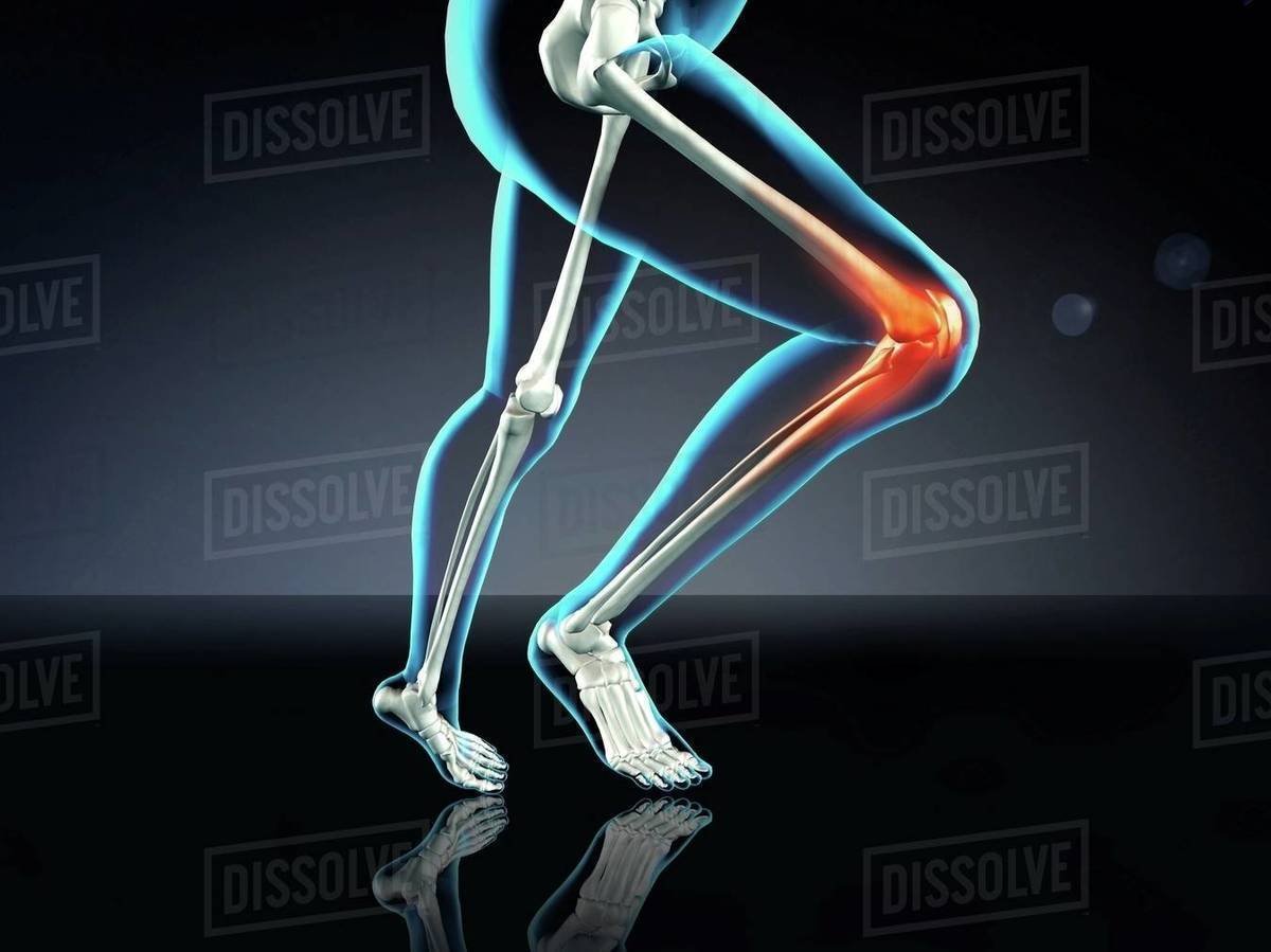 Blue X-ray of woman's knee pain while running on dark blue background ...