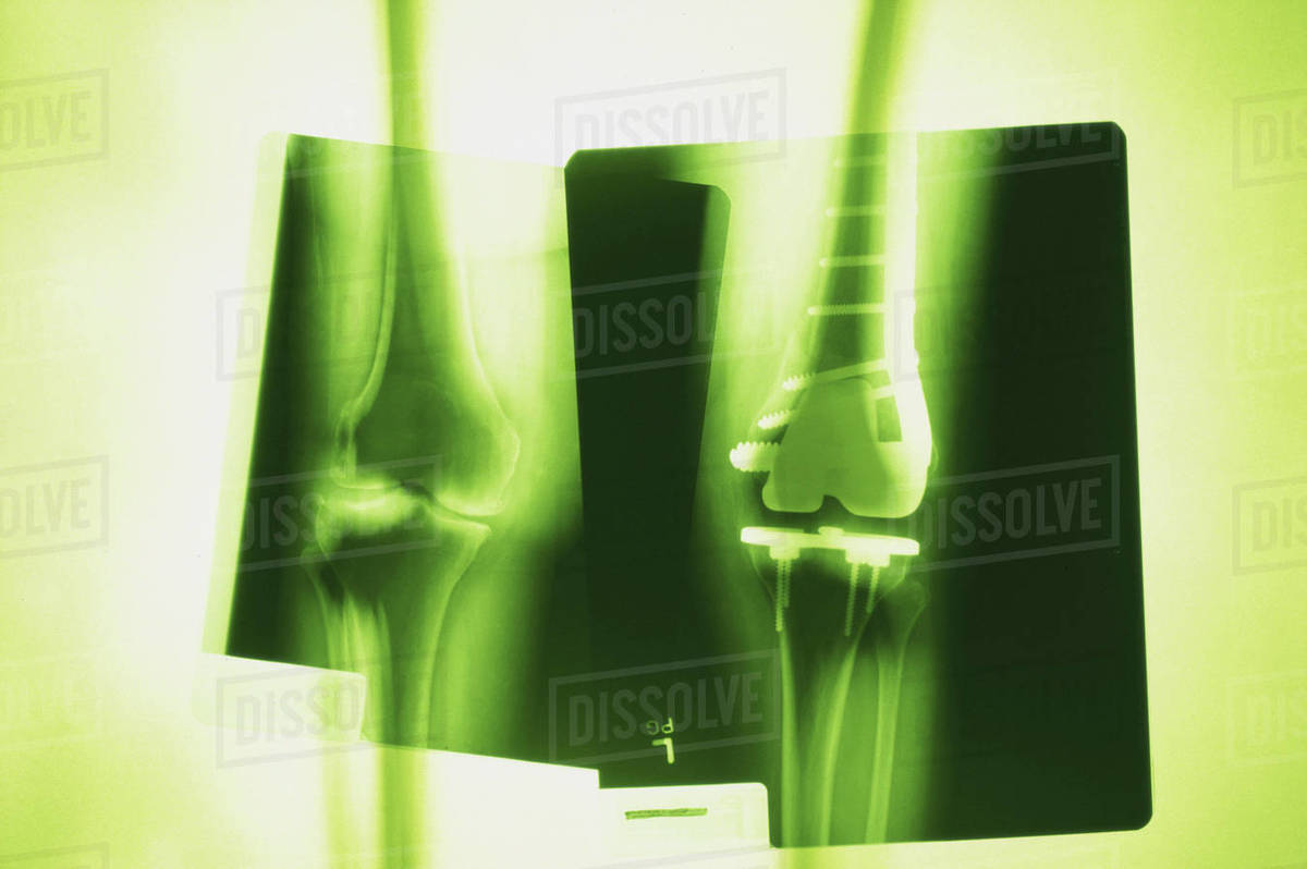 X-ray of a human leg with metal screws and rods - Royalty-free Stock ...