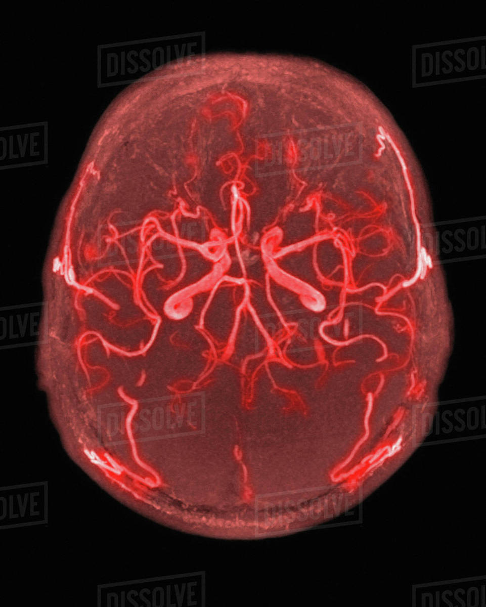 Normal arterial blood supply to the brain - Royalty-free Stock Photo ...