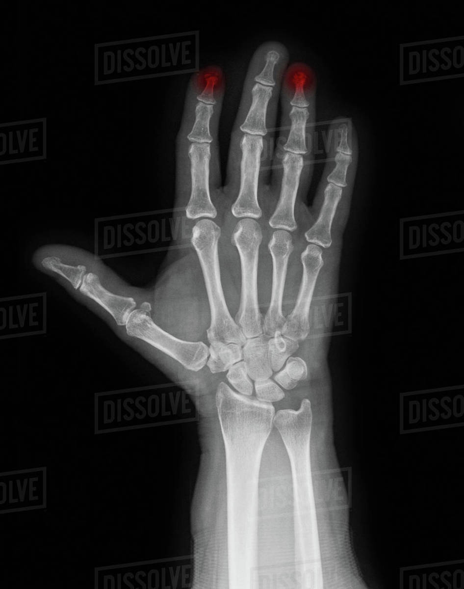 X-ray of hand with crushed index finger - Stock Photo - Dissolve
