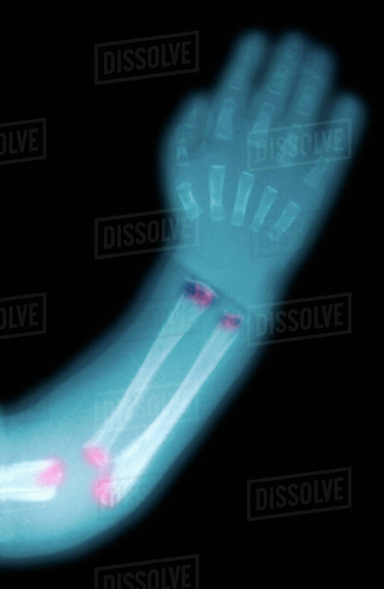 Congenital syphilis: forearm xray of newborn - Royalty-free Stock Photo ...