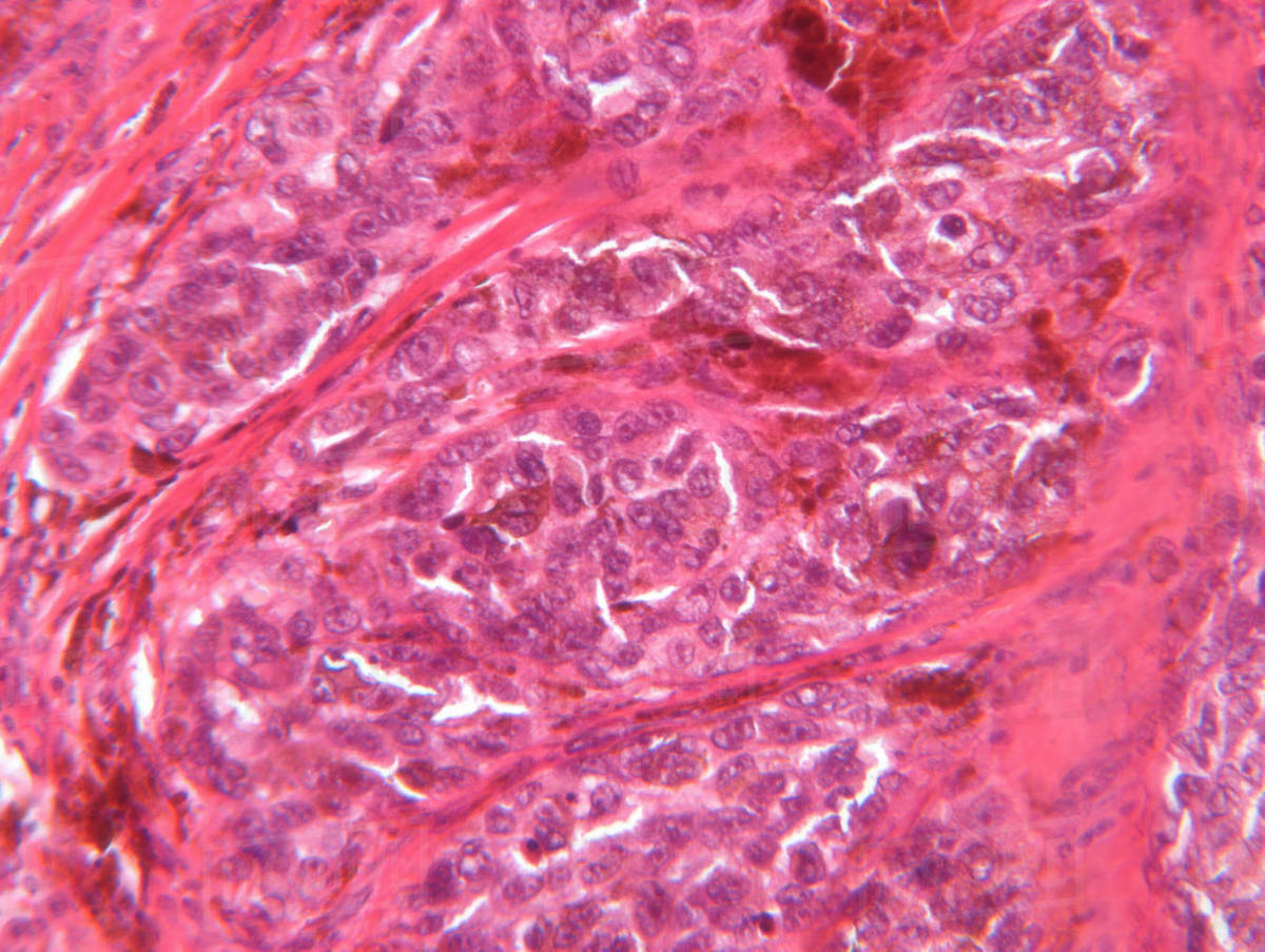 Microscope view of malignant melanoma - Stock Photo - Dissolve