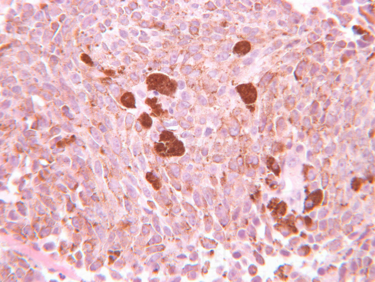Microscope view of malignant melanoma - Royalty-free Stock Photo | Dissolve