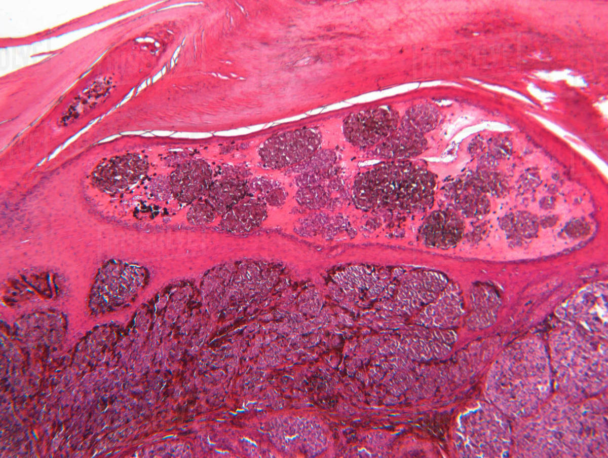 Microscope view of malignant melanoma - Royalty-free Stock Photo | Dissolve