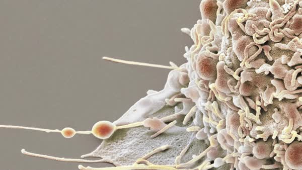 Mouth cancer cell. Animated coloured scanning electron micrograph (SEM ...