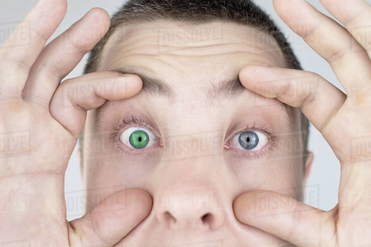 A man with different color eyes looks into the frame. The right eye is ...