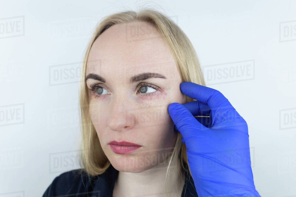 Allergy to cosmetics. The girl looks at the pimples around her eyes ...