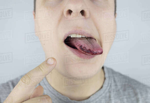 Black tongue. A man shows the consequences of an injury, bite or burn ...