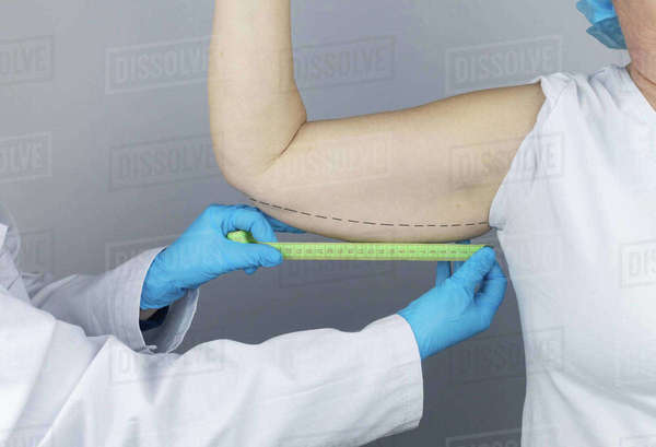 Brachioplasty. Plastic arms, dangling skin at the elbow. An older woman ...
