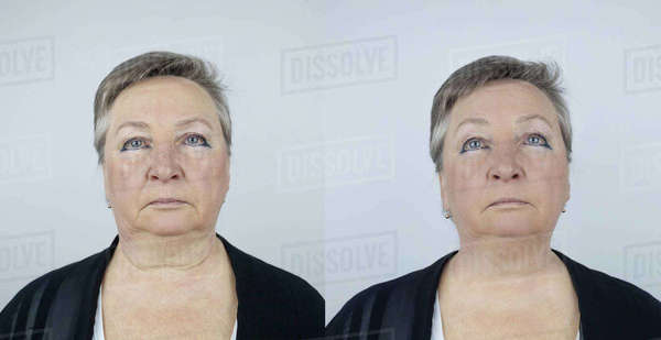 Second chin lift in senior woman. Photos before and after plastic ...