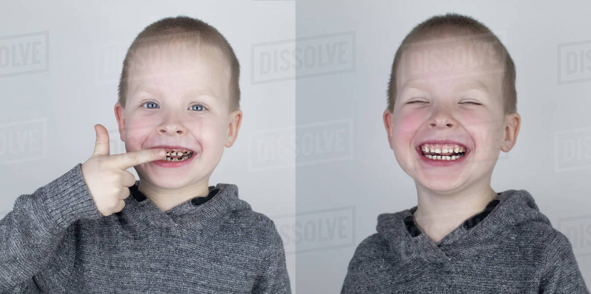 Before and after. The child shows the damaged teeth by caries, and in ...