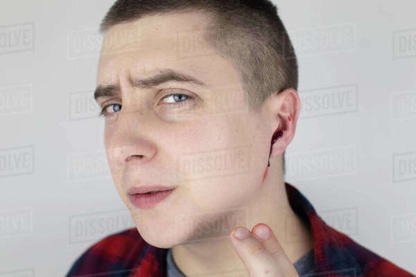 A man whose ear is bleeding. Vascular rupture, damage to the tympanic ...