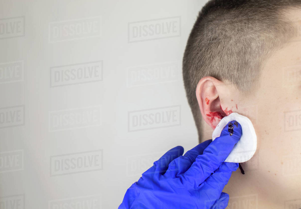 A man whose ear is bleeding. Vascular rupture, damage to the tympanic ...
