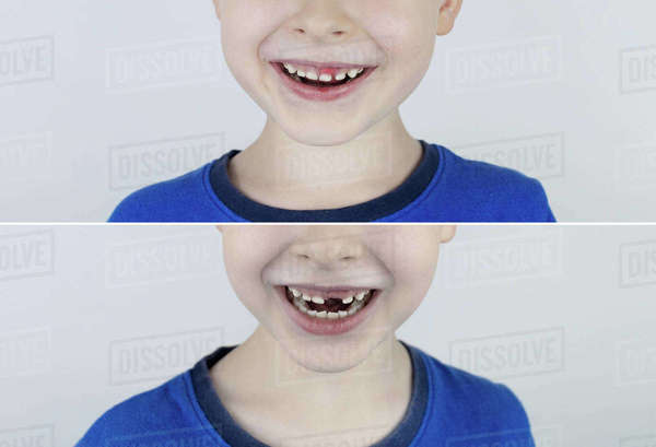 Before and after. Falling out milk tooth. Blond boy in photo has a ...