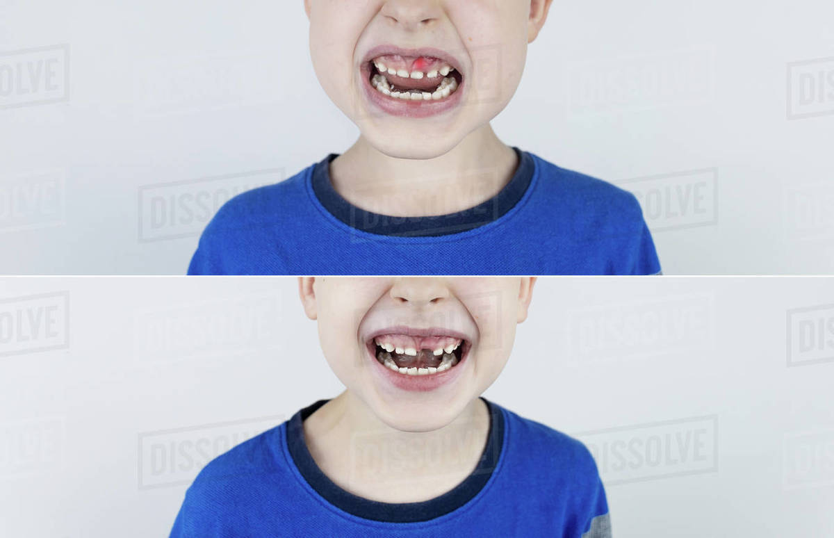Before and after. Falling out milk tooth. Blond boy in photo has a ...