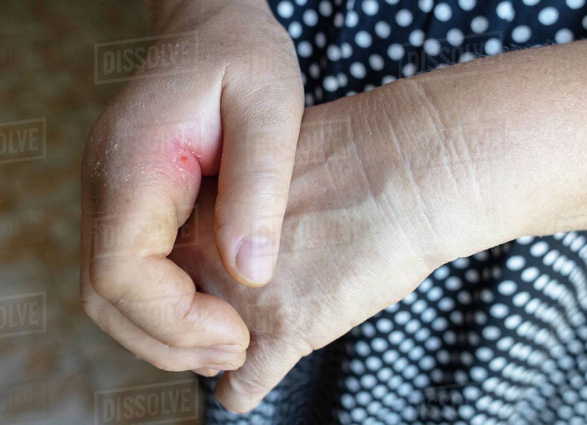 Close-up hand inflammation. Left hand was very swollen in region of the ...