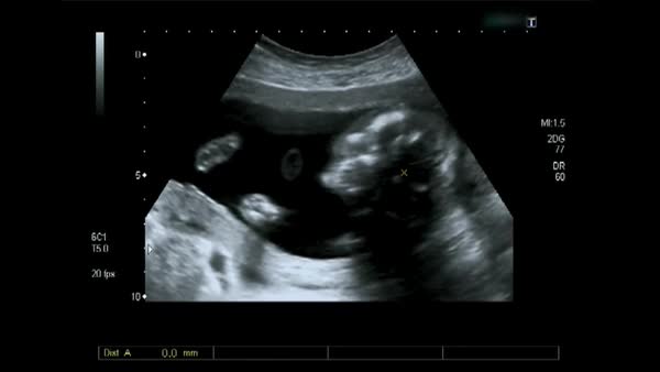 Ultrasonography of Fetus inside woman's womb, heart ecography - HD ...