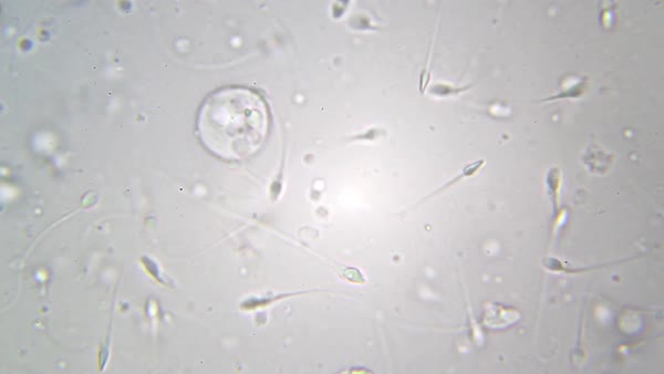 Sperm sample of a healthy man, seen under biological microscope, an ...