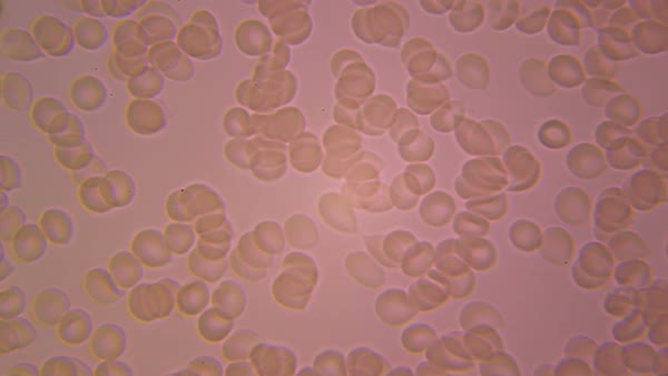 Microscopy: Human Blood. Blood Clots Under Microscope. Red Blood Cells ...