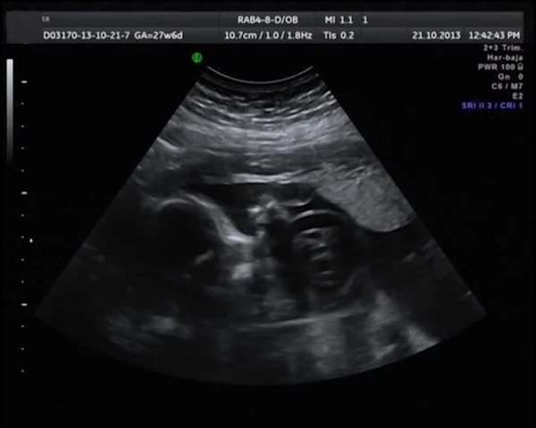 Echography the Ultrasound. Medical ultrasound scan of human embryo ...