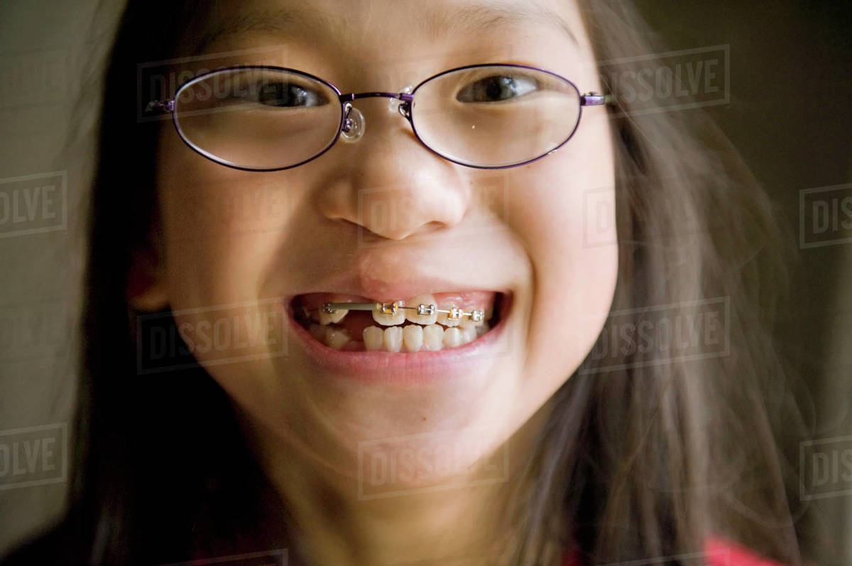 Close-up portrait of a girl with repaired cleft lip and braces smiles ...