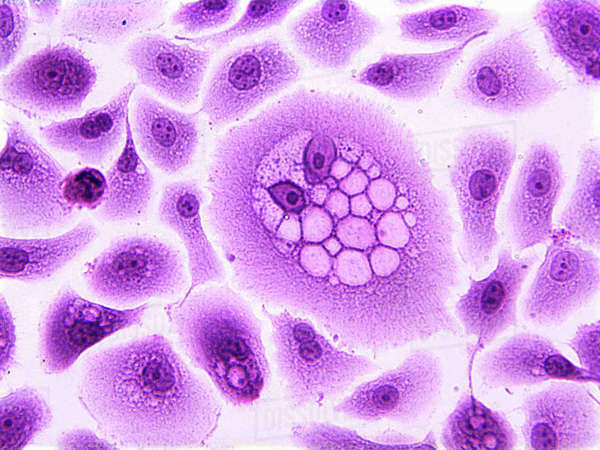 Koilocytes, squamous epithelial cells, altered by human papillomavirus ...