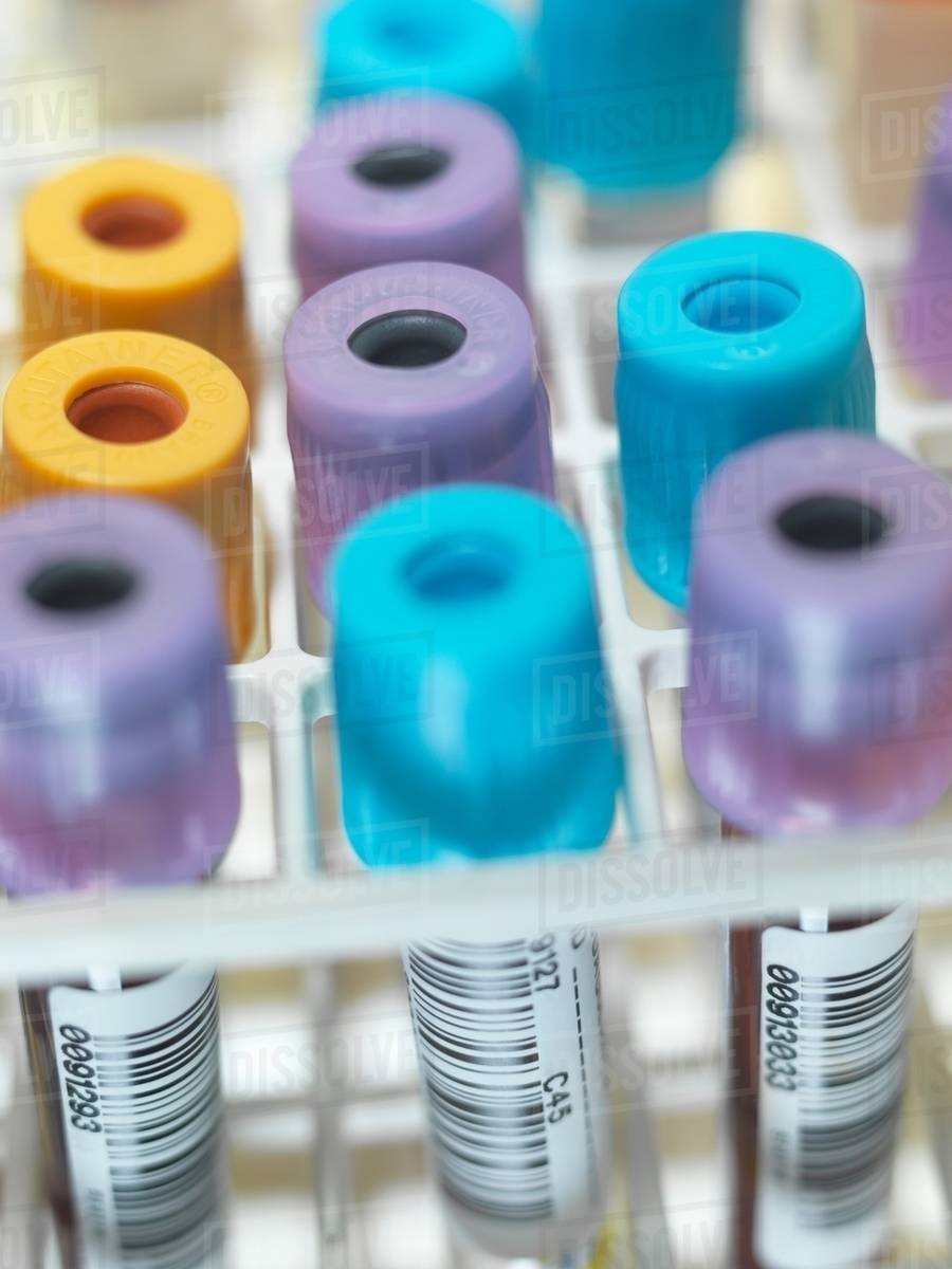 A row of human blood and chemistry samples awaiting testing in the lab ...