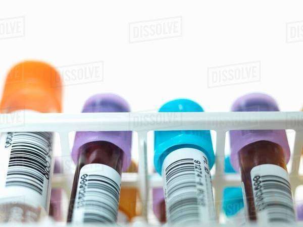 A row of human blood and chemistry samples awaiting testing in the lab ...