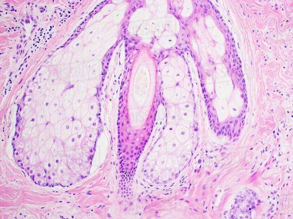 H&E stain, light microscopy, rheumatoid arthritis of joint showing ...