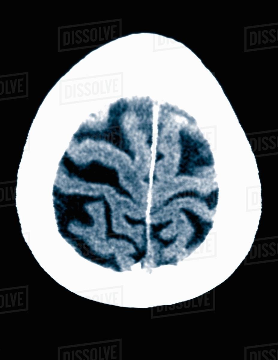 CT scan 84 year old male with Alzheimer's disease. CT shows brain ...