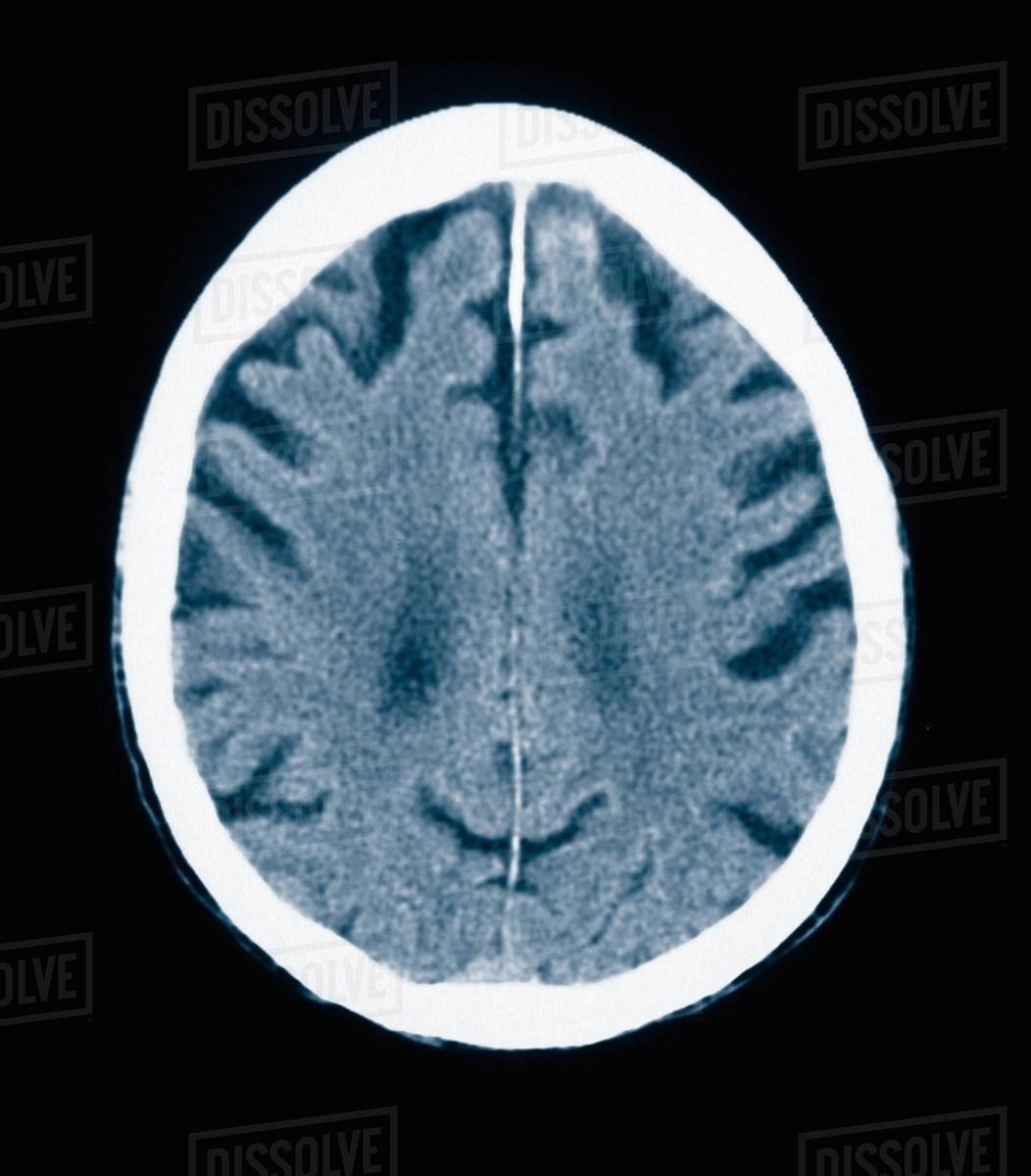 CT scan 84 year old male with Alzheimer's disease. CT shows brain ...